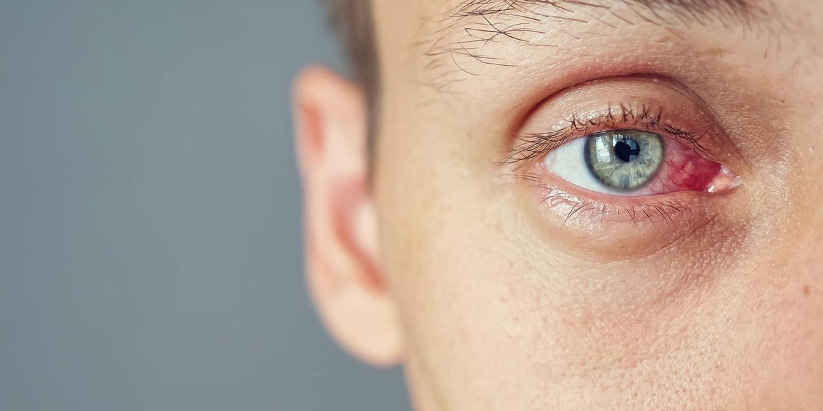 Understanding Eye Infections: Causes, Symptoms, and Treatment Options